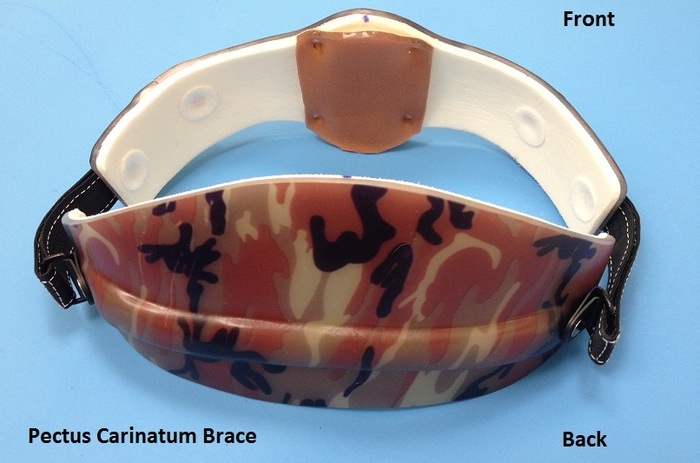 Pectus Carinatum | UCSF Department of Surgery