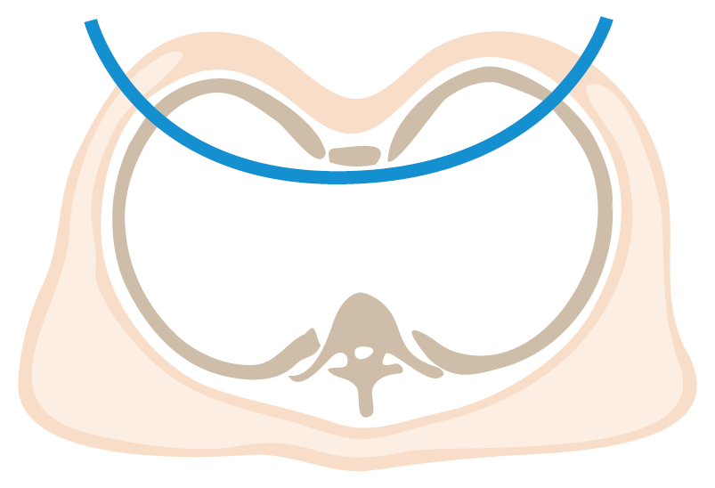 Pectus Excavatum | UCSF Department of Surgery