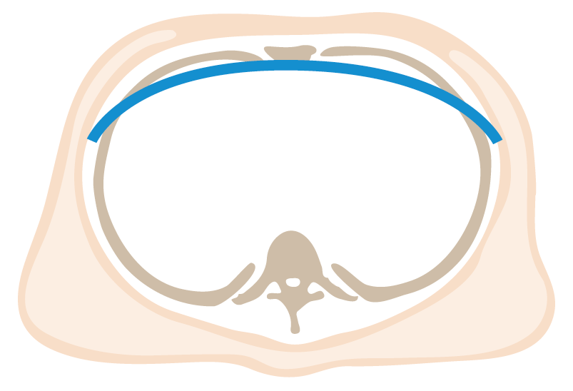 Pectus Excavatum | UCSF Department of Surgery