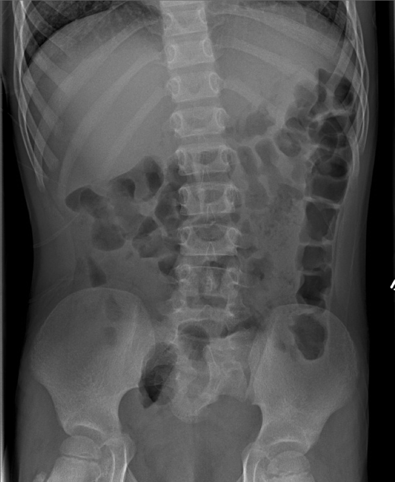 Anorectal Malformation | UCSF Department of Surgery